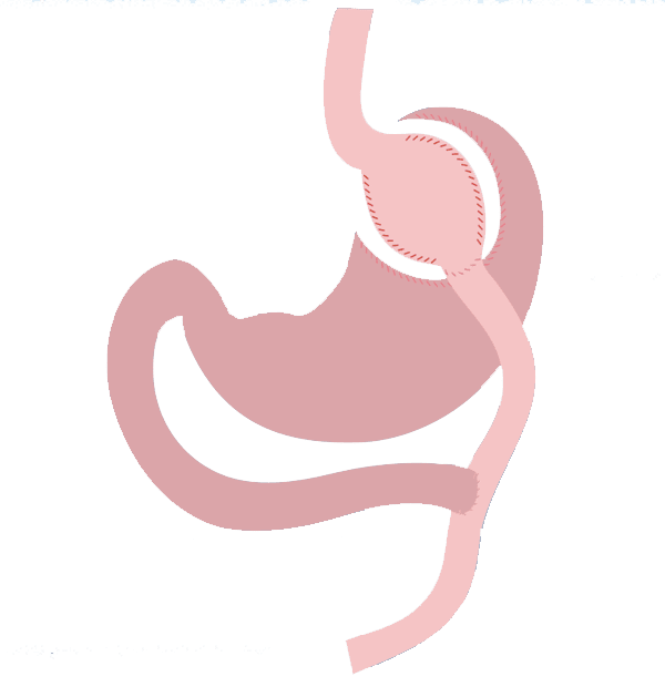 Gastric Bypass Surgery – Weight Loss Surgery in Puerto Vallarta